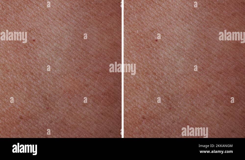 Very dry skin Stock Videos & Footage - HD and 4K Video Clips - Alamy