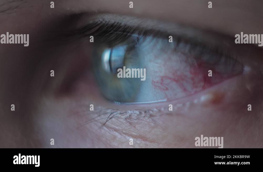 Close up of tired eye. Burst blood vessel in the eye. Blood capillary ...
