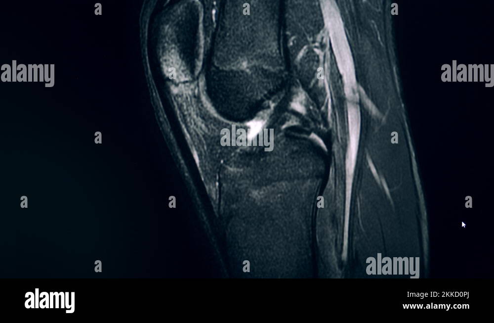Ct scan of knee Stock Videos & Footage - HD and 4K Video Clips - Alamy