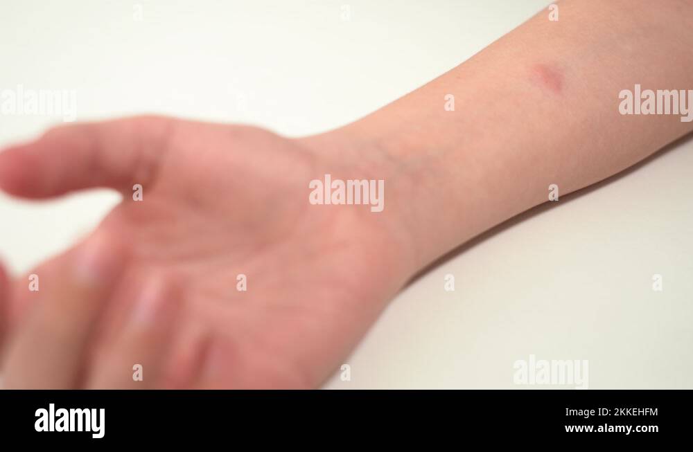 Tuberculosis skin test Stock Videos & Footage - HD and 4K Video Clips ...