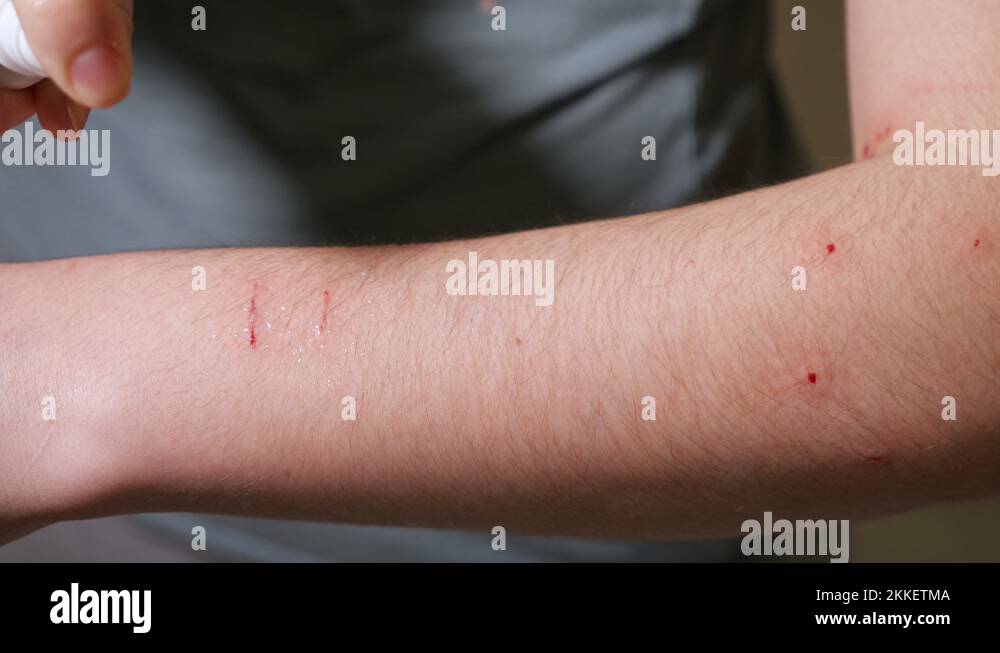 Woman handles scratches and bites on her arm Stock Video Footage - Alamy