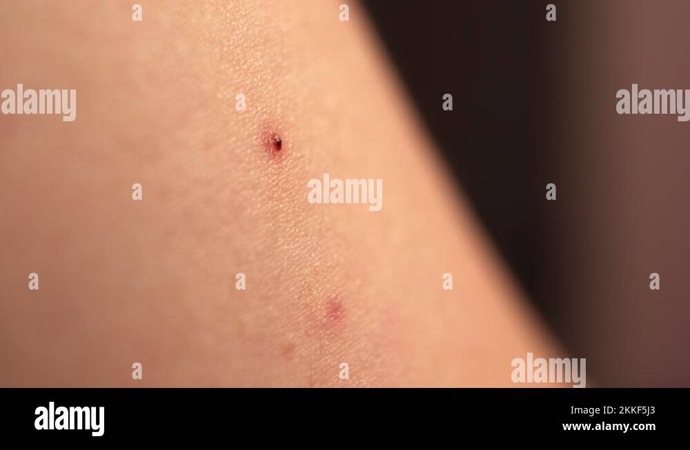 Pimple wound on the skin. Macro photography Stock Video Footage - Alamy