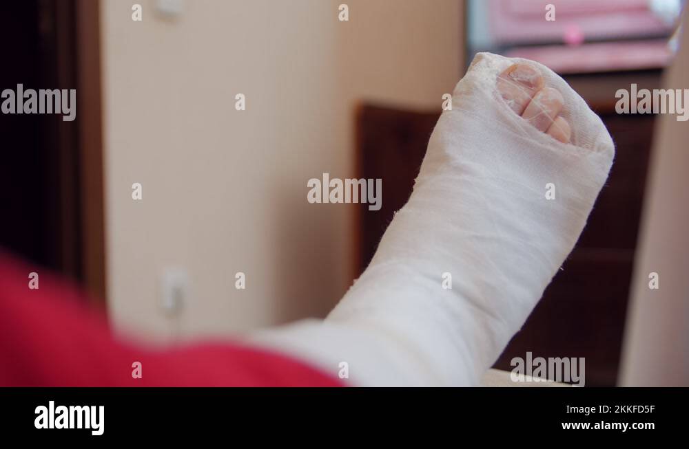 Leg cast girl Stock Videos & Footage - HD and 4K Video Clips - Alamy