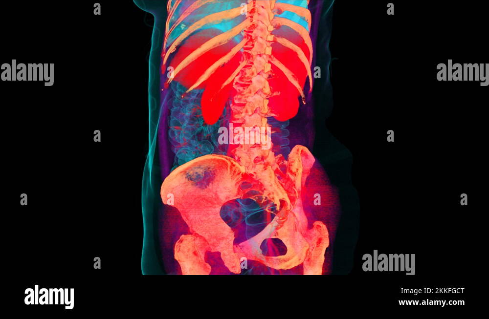 Computed tomography. Virtual colonoskopy VR reconstruction. Prevention ...