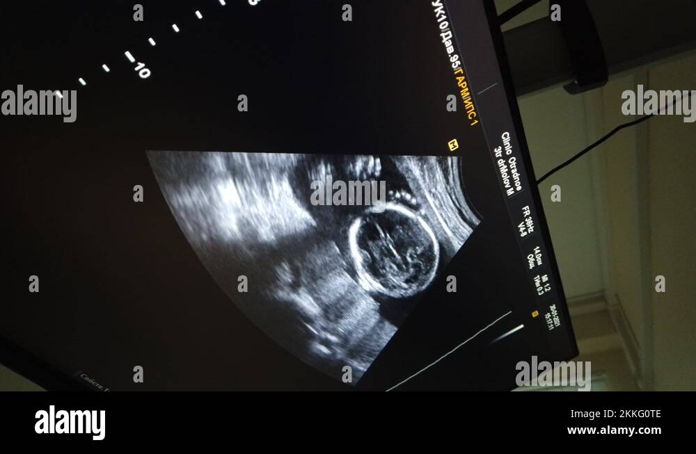 Medical ultrasound scanning, baby silhouette on the screen. Ultrasound ...