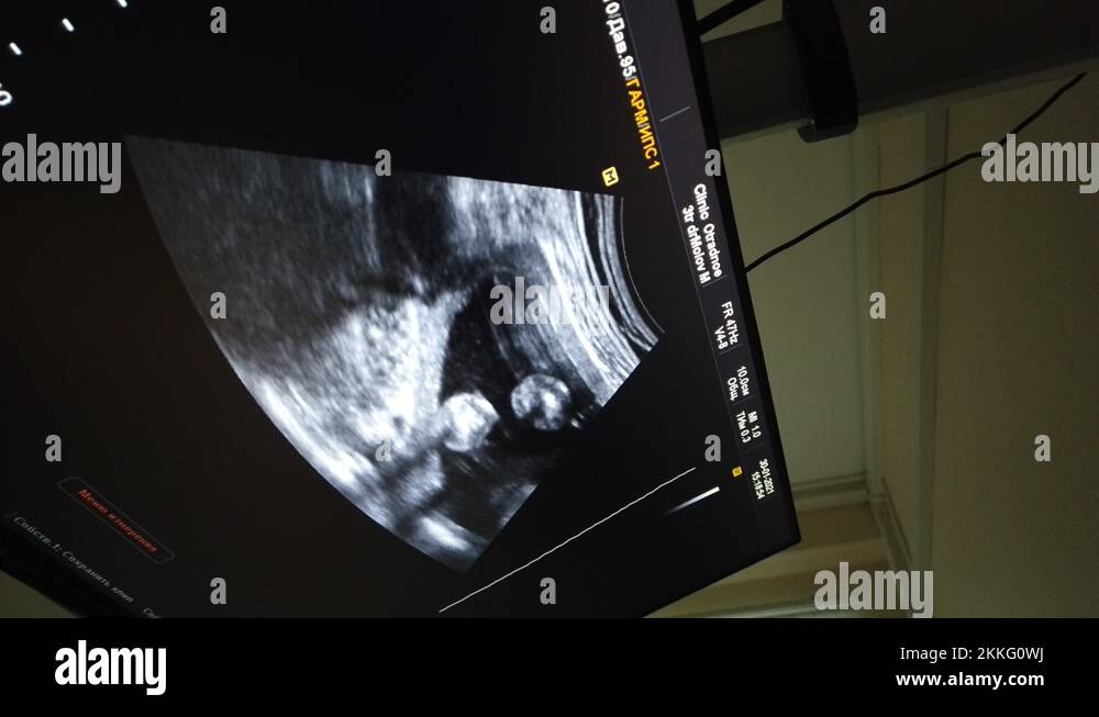 Medical ultrasound scanning, baby silhouette on the screen. Ultrasound ...