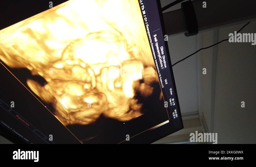 Medical ultrasound scanning, baby silhouette on the screen. Ultrasound ...