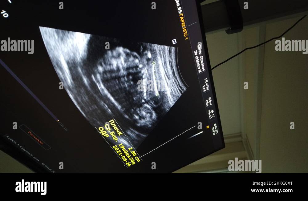 Medical ultrasound scanning, baby silhouette on the screen. Ultrasound ...