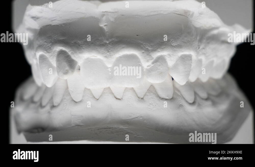 Plaster teeth Stock Videos & Footage - HD and 4K Video Clips - Alamy