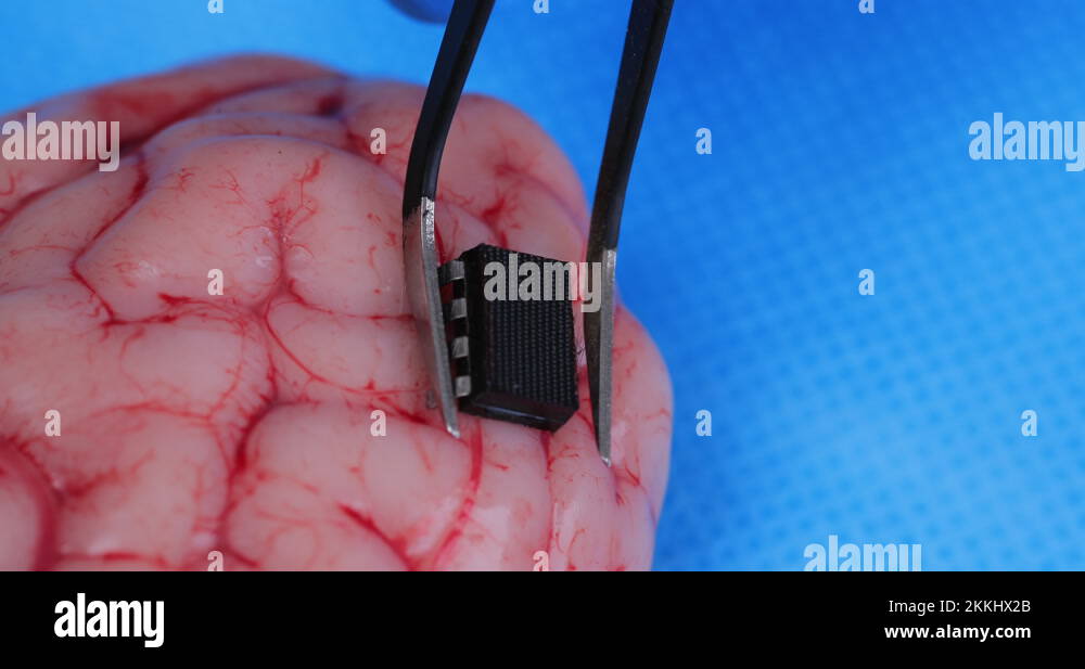 Open brain surgery. Modern treatment of brain diseases Stock Video ...
