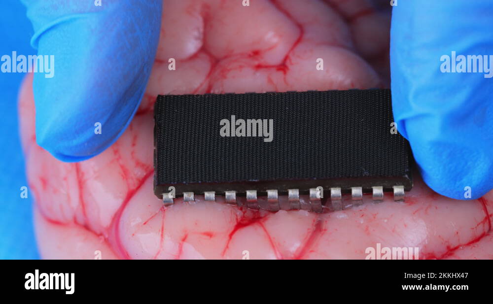 Open brain surgery. Modern treatment of brain diseases Stock Video ...