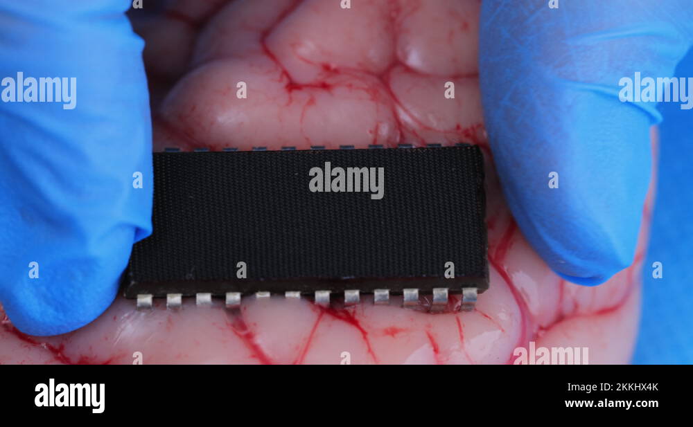 Open brain surgery. Modern treatment of brain diseases Stock Video ...