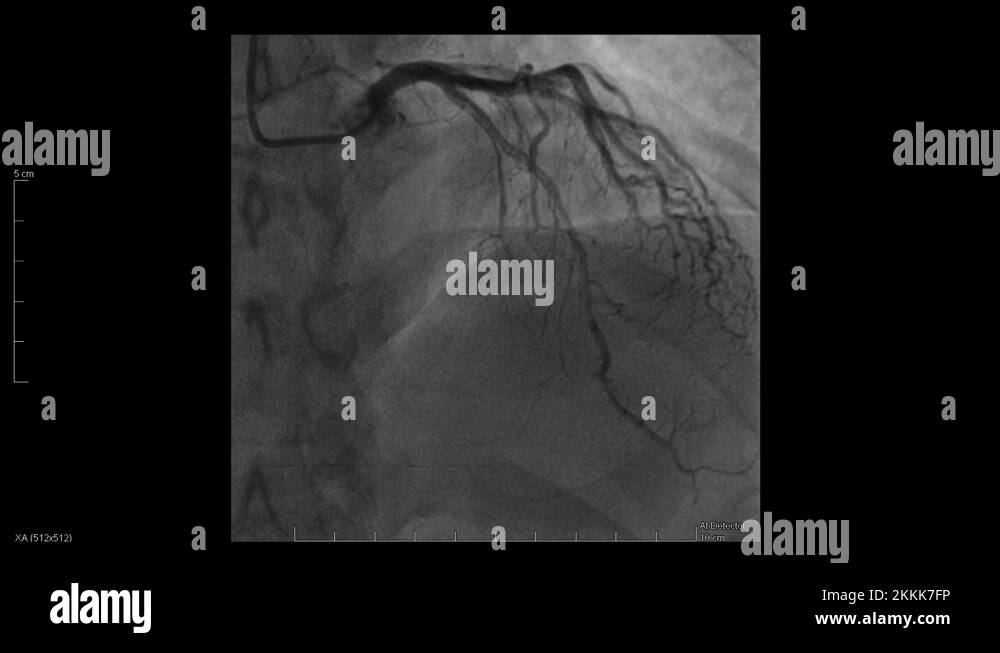 Coronary imaging catheter Stock Videos & Footage - HD and 4K Video ...