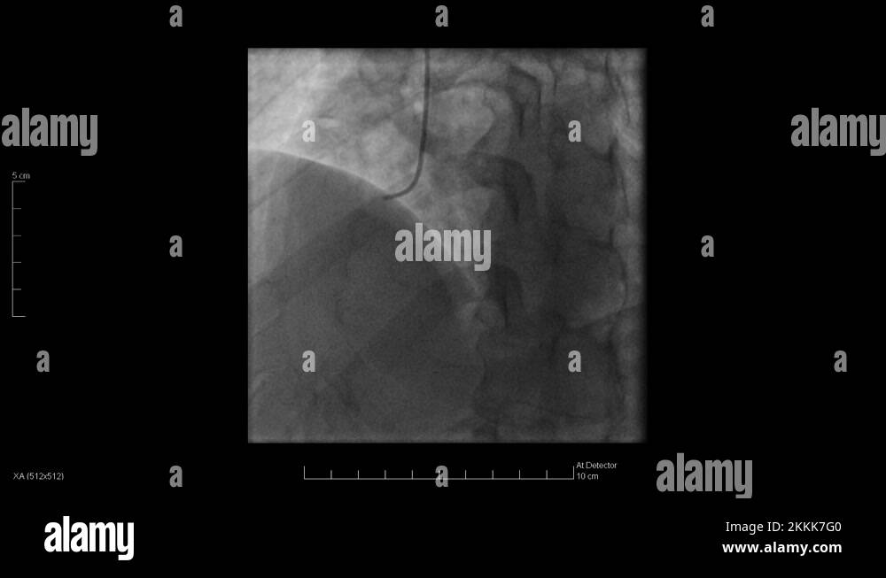 Medical imaging of a cardiac catheterization of the right coronary ...