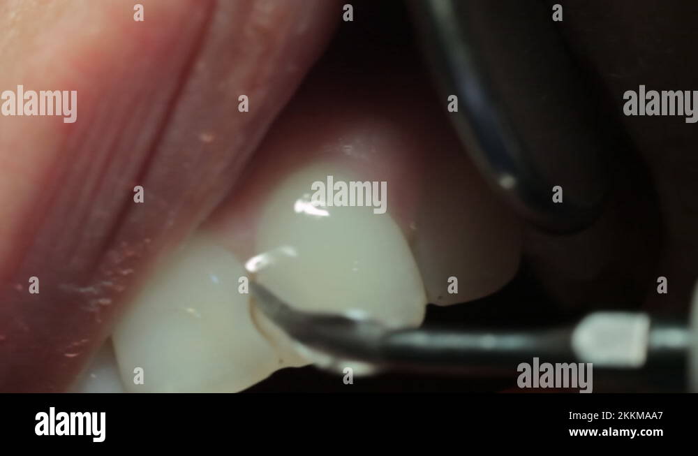 Hygienist cleaning Stock Videos & Footage - HD and 4K Video Clips - Alamy