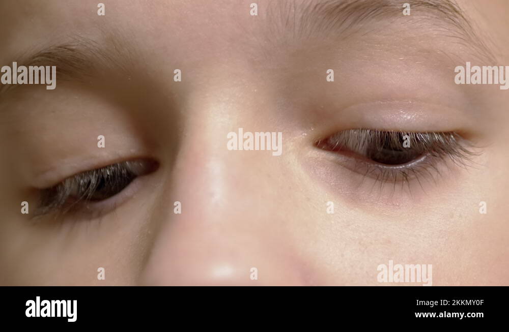 Facial drooping Stock Videos & Footage - HD and 4K Video Clips - Alamy