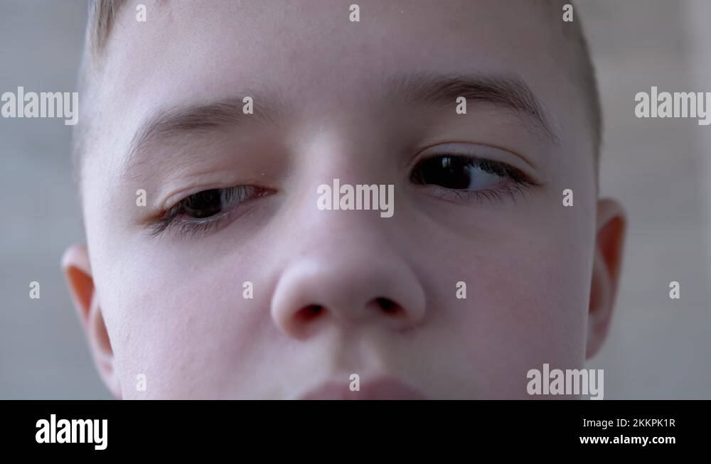 Boy Teen with Drooping Upper of Eyelid, Long Lashes, Rotates eyes ...