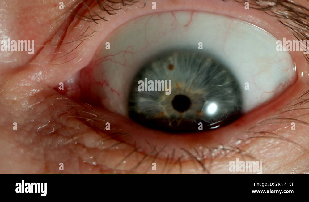 Bulging eye Stock Videos & Footage - HD and 4K Video Clips - Alamy