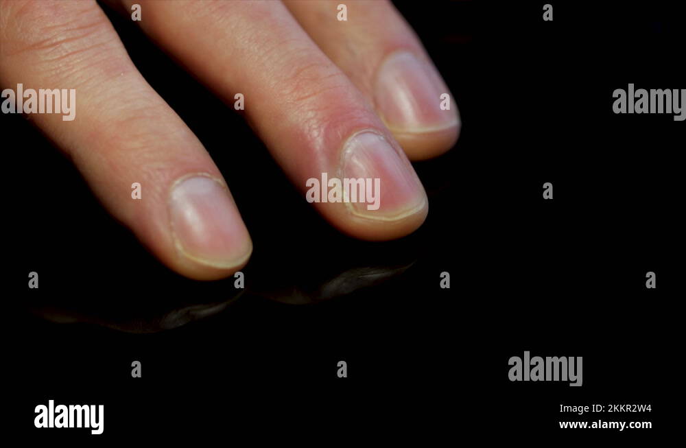 Ingrown nail Stock Videos & Footage - HD and 4K Video Clips - Alamy