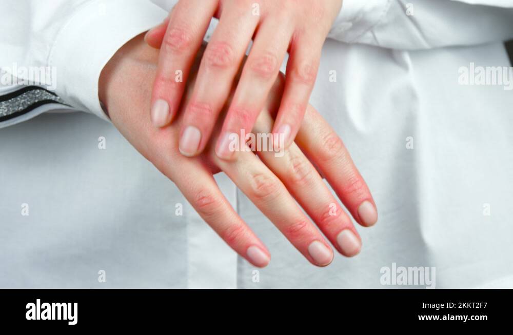 Allergic dermatitis on the skin. A woman scratches the itchy skin of ...