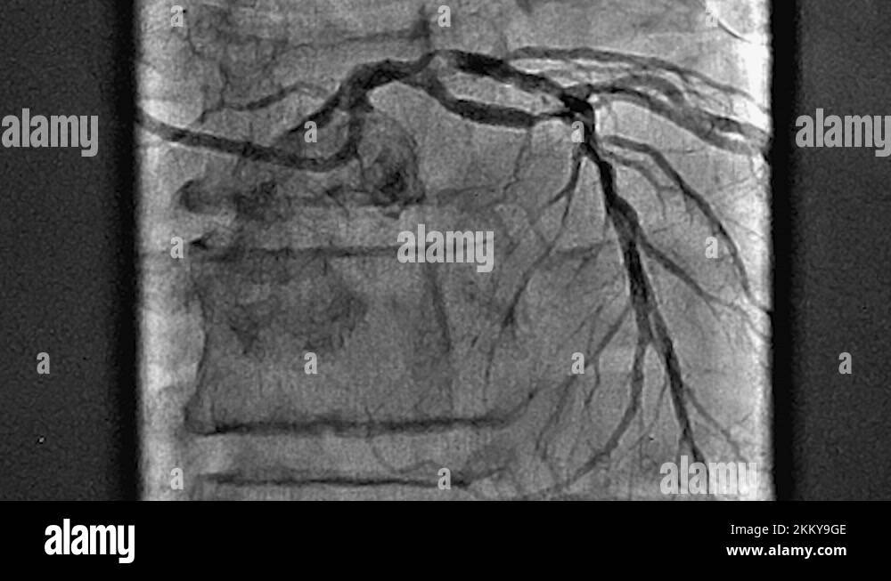 Medical Angiogram X-ray Of A Beating Heart, Diagnostic And Treatment ...