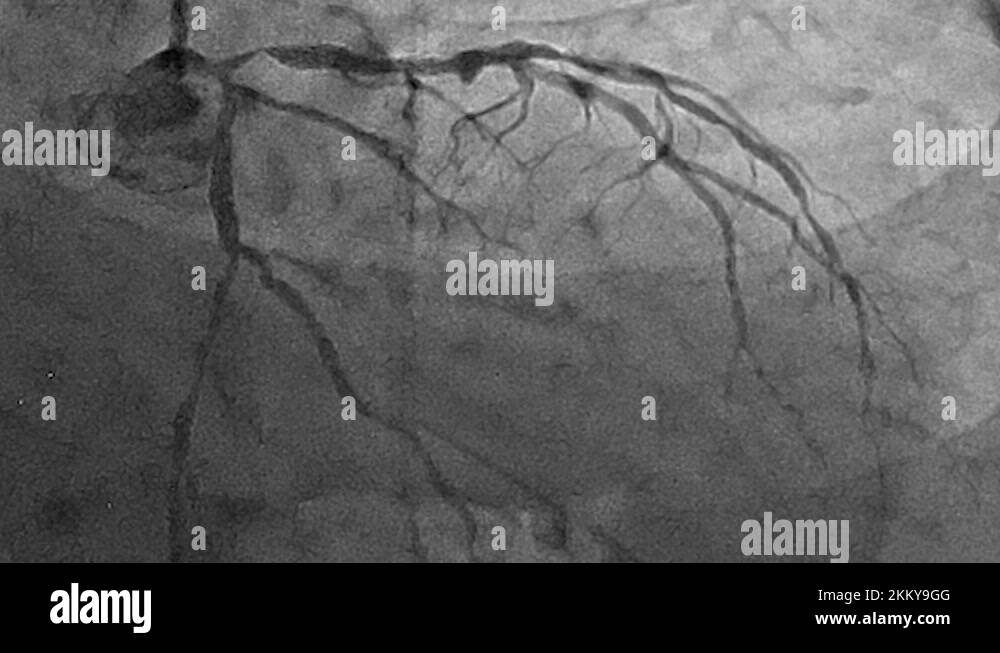 Pulmonary angiogram Stock Videos & Footage - HD and 4K Video Clips - Alamy