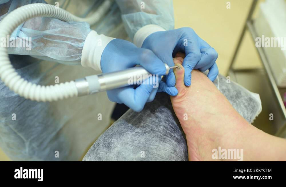 close-up - a doctor or a pedicure master treats the patient's nails ...