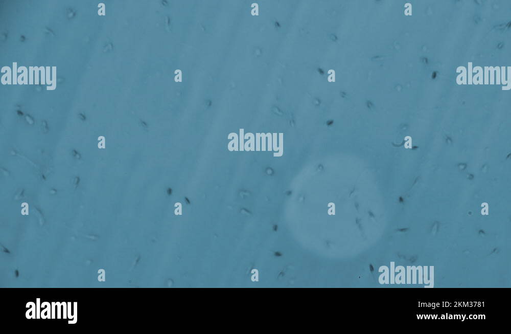 Microbiological examination of human semen. Sperm under a microscope ...