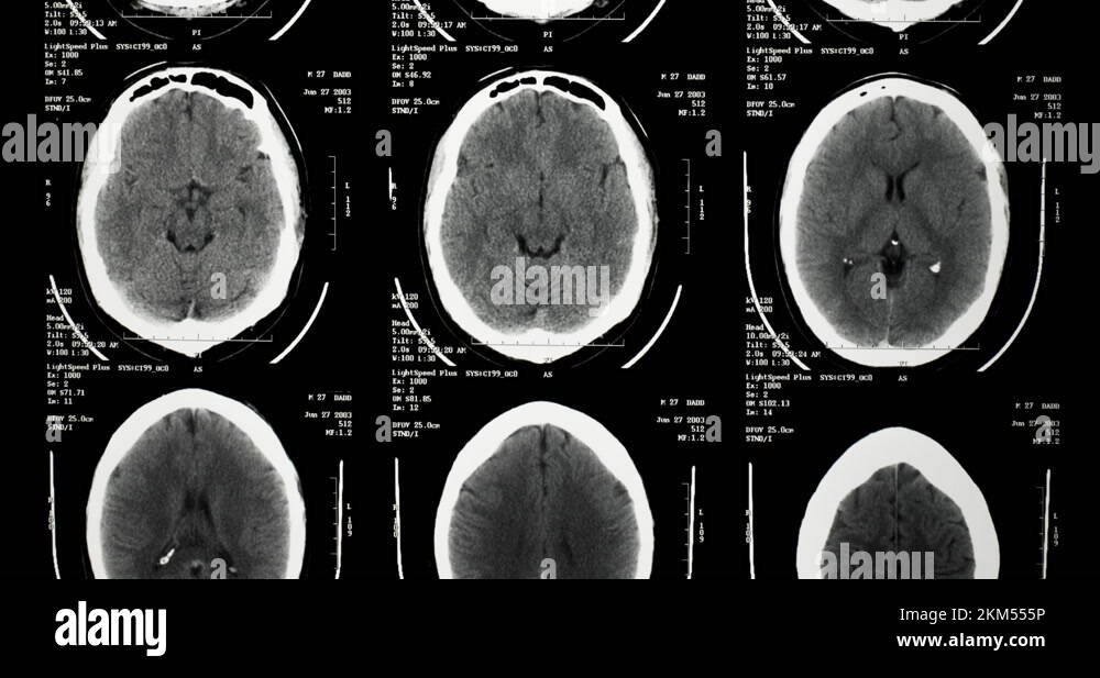 X ray head brain radiography Stock Videos & Footage - HD and 4K Video ...