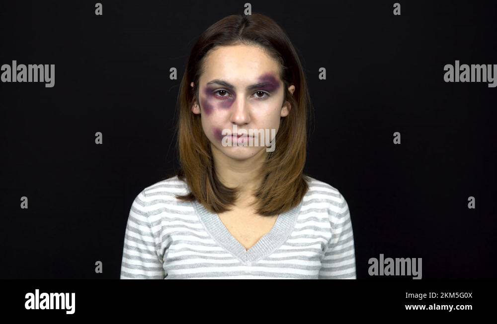 Young woman bruises face Stock Videos & Footage - HD and 4K Video Clips ...
