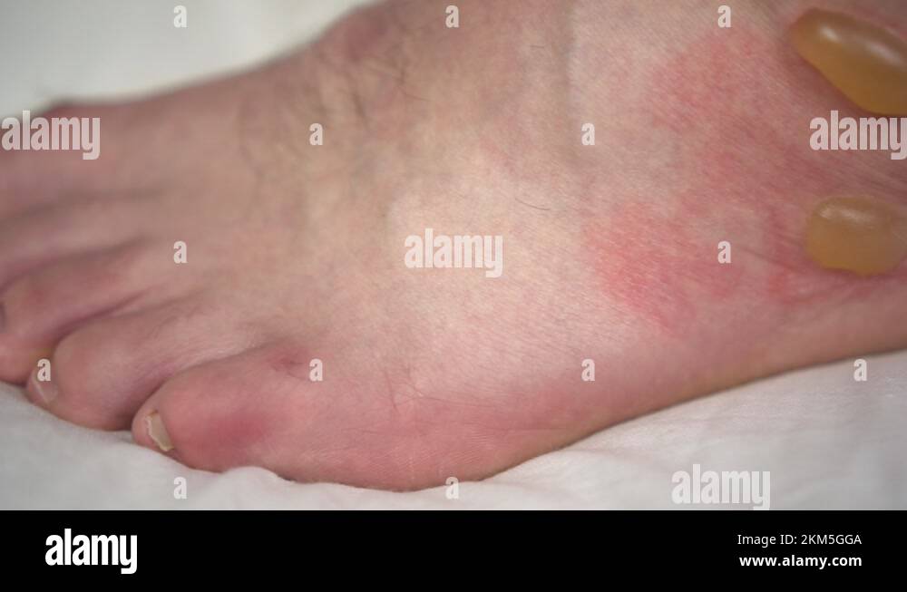 Second degree burn skin Stock Videos & Footage - HD and 4K Video Clips ...