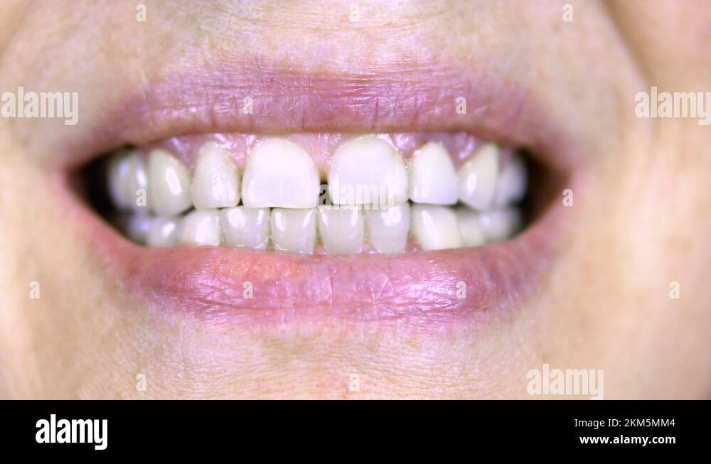 Upper and lower teeth Stock Videos & Footage - HD and 4K Video Clips ...