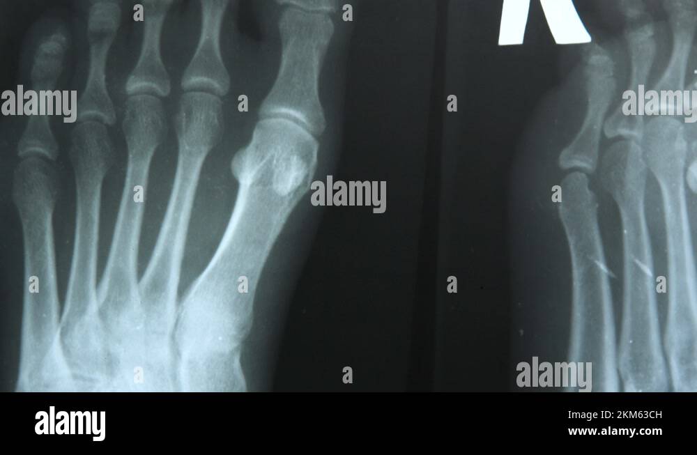 X-ray of the feet close-up. X-ray image from top to bottom Stock Video ...