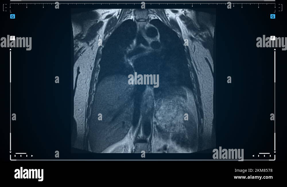 MRI lung scan, magnetic resonance imaging of a back and skeleton close ...