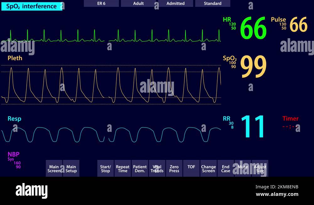 EKG monitor realistic animation loop, patient stable and resting Stock ...