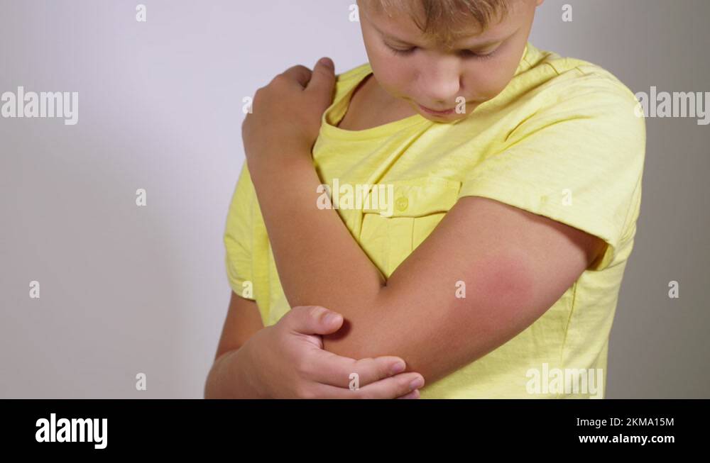 Kid looks at big red spot on skin of arm caused by allergy reaction to ...