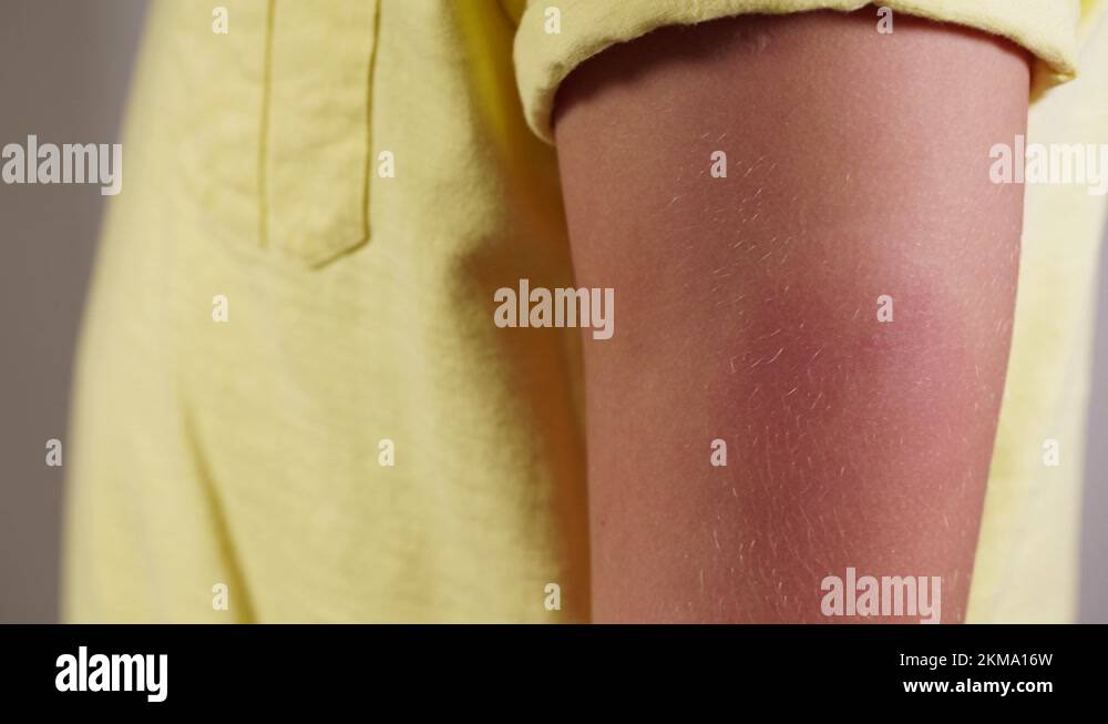 Kid looks at big red spot on skin of arm caused by allergy reaction to ...