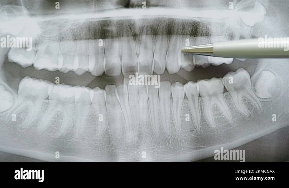 Close up view of Dentist examines a panoramic x-ray of the teeth shows ...