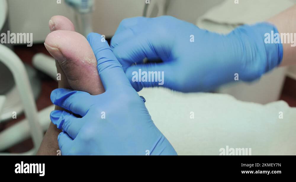 Podiatry cutting dead skin and calluses on the sole of the left foot ...
