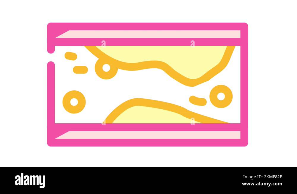 Cholesterol plaques Stock Videos & Footage - HD and 4K Video Clips - Alamy