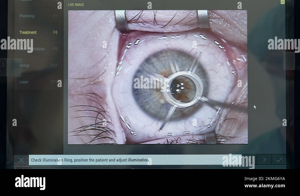 Interface of a computer program with eye surgery shown in it Stock ...