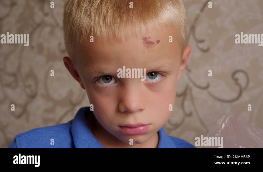 Portrait of a sad little boy with a scratch and a bump on his forehead ...