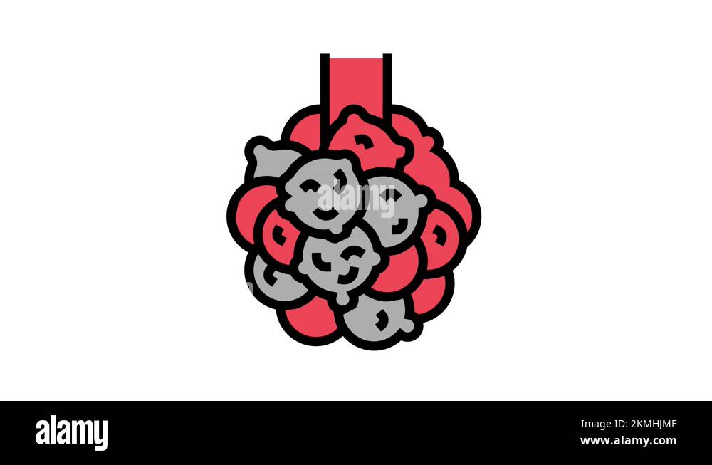 Bronchiectasis x ray Stock Videos & Footage - HD and 4K Video Clips - Alamy