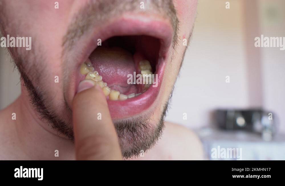 Close-up. Open Male Mouth with Teeth. Man Shows Teeth. Filled Tooth in ...