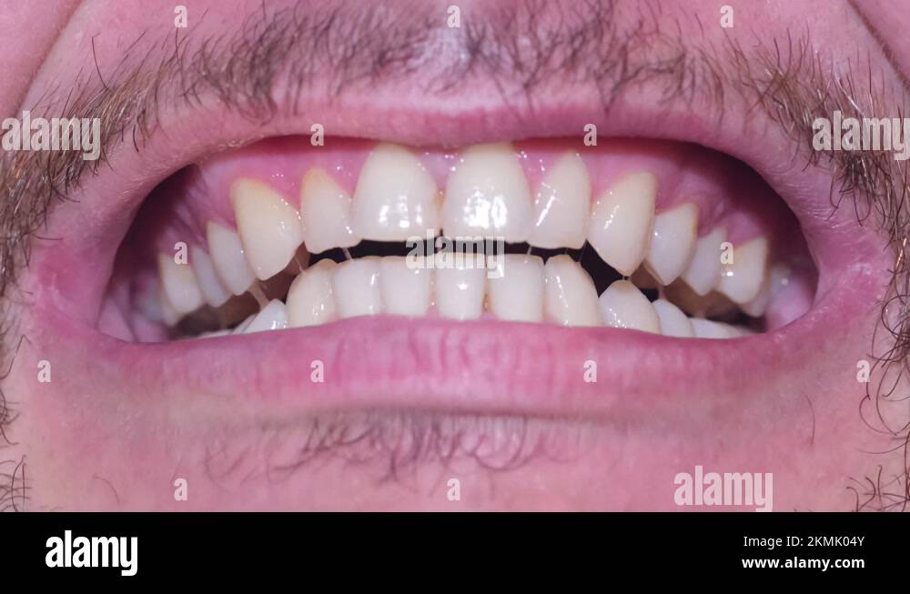 Compress the teeth Stock Videos & Footage - HD and 4K Video Clips - Alamy