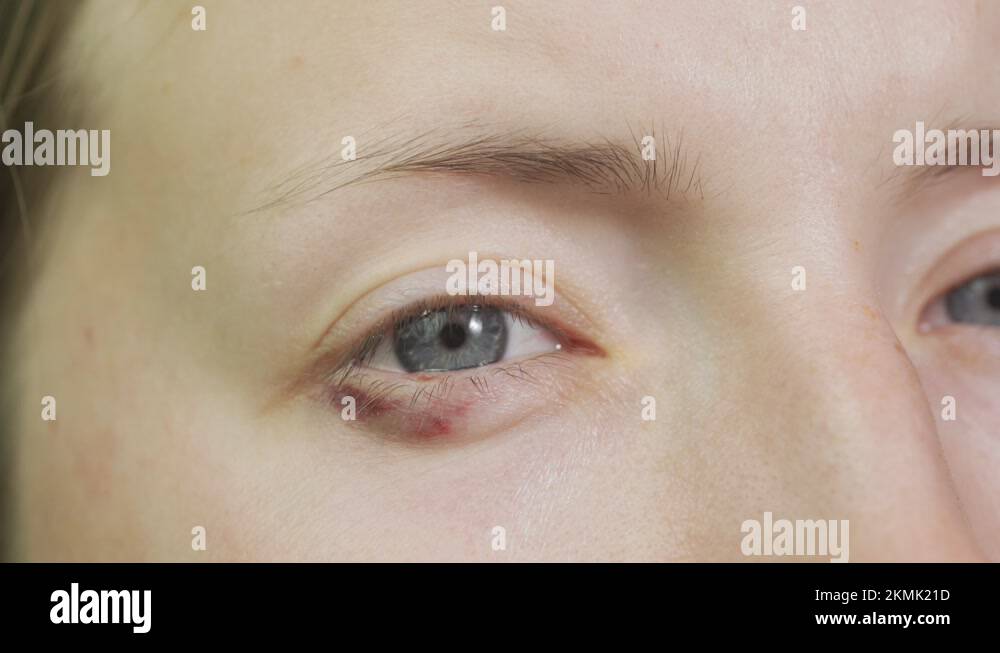Allergy under the eye. Redness on the skin. Dermatology Stock Video ...
