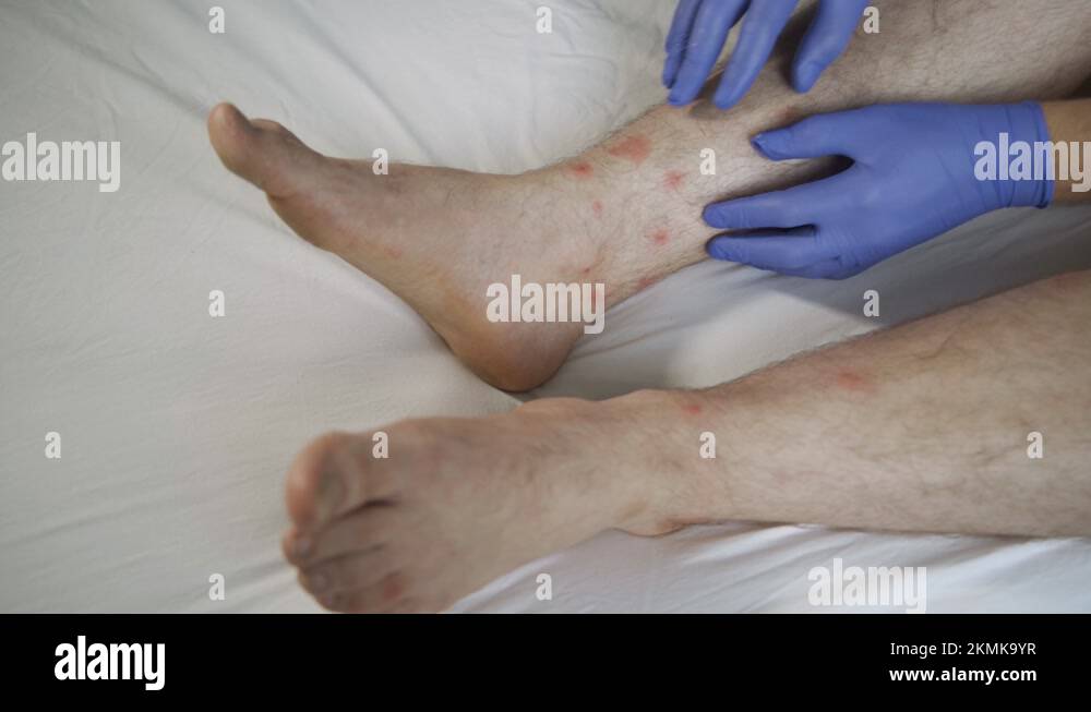 Dermatitis feet Stock Videos & Footage - HD and 4K Video Clips - Alamy