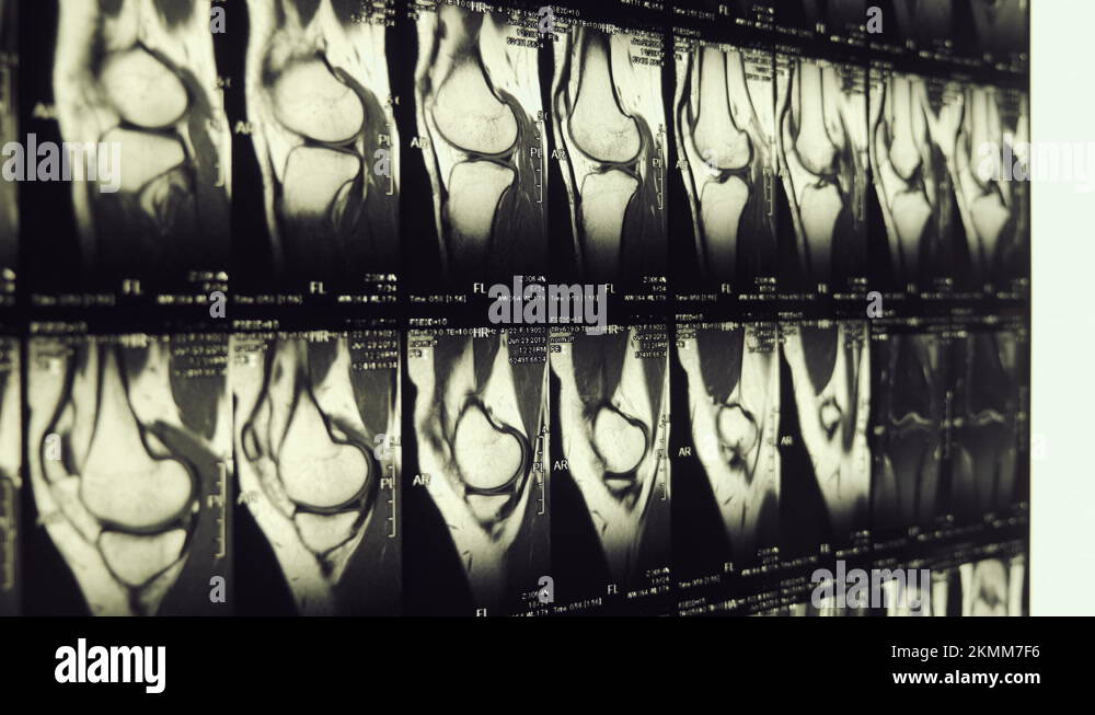 Magnetic resonance imaging (MRI) of the knee joint. Closeup. Macro ...