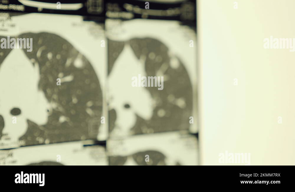 Magnetic resonance imaging (MRI) of the chest and lung Stock Video ...