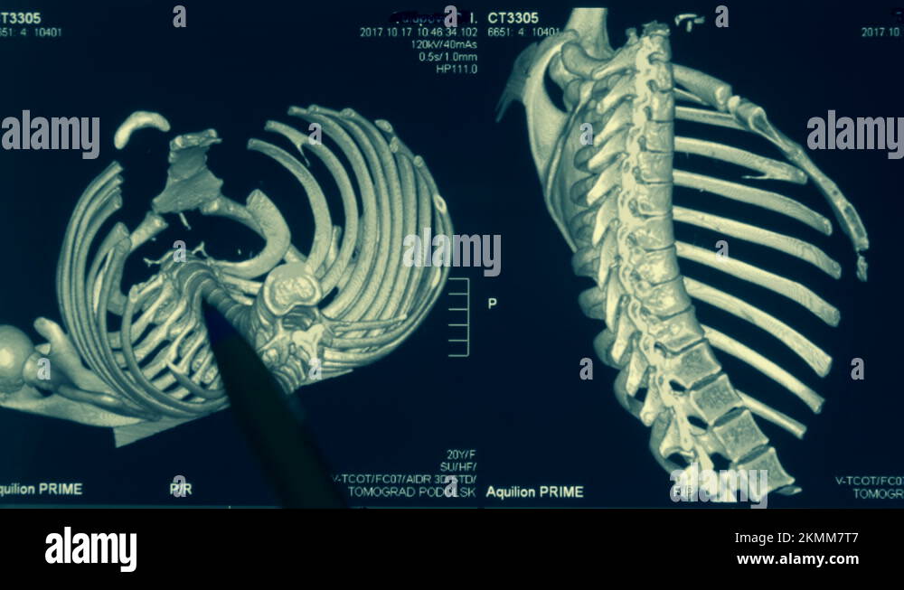 Magnetic resonance imaging (MRI) of the human chest with ribs and spine ...